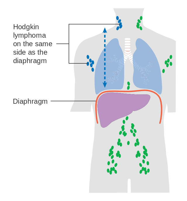 Stage 2 Follicular Non-Hodgkin Lymphoma Diagnosis